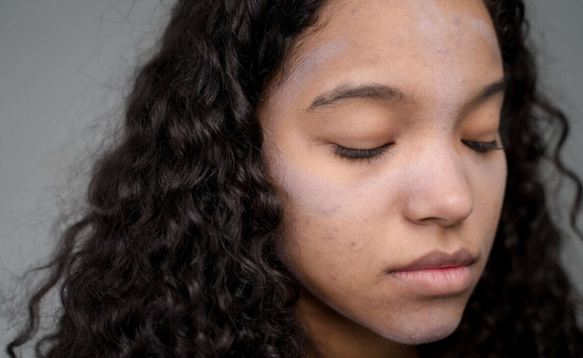 Guide To Common Facial Skin Conditions | UpCircle - UpCircle Beauty Europe